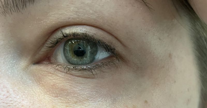 What Causes Yellowing of The Skin Around The Eyes? – Afterthought