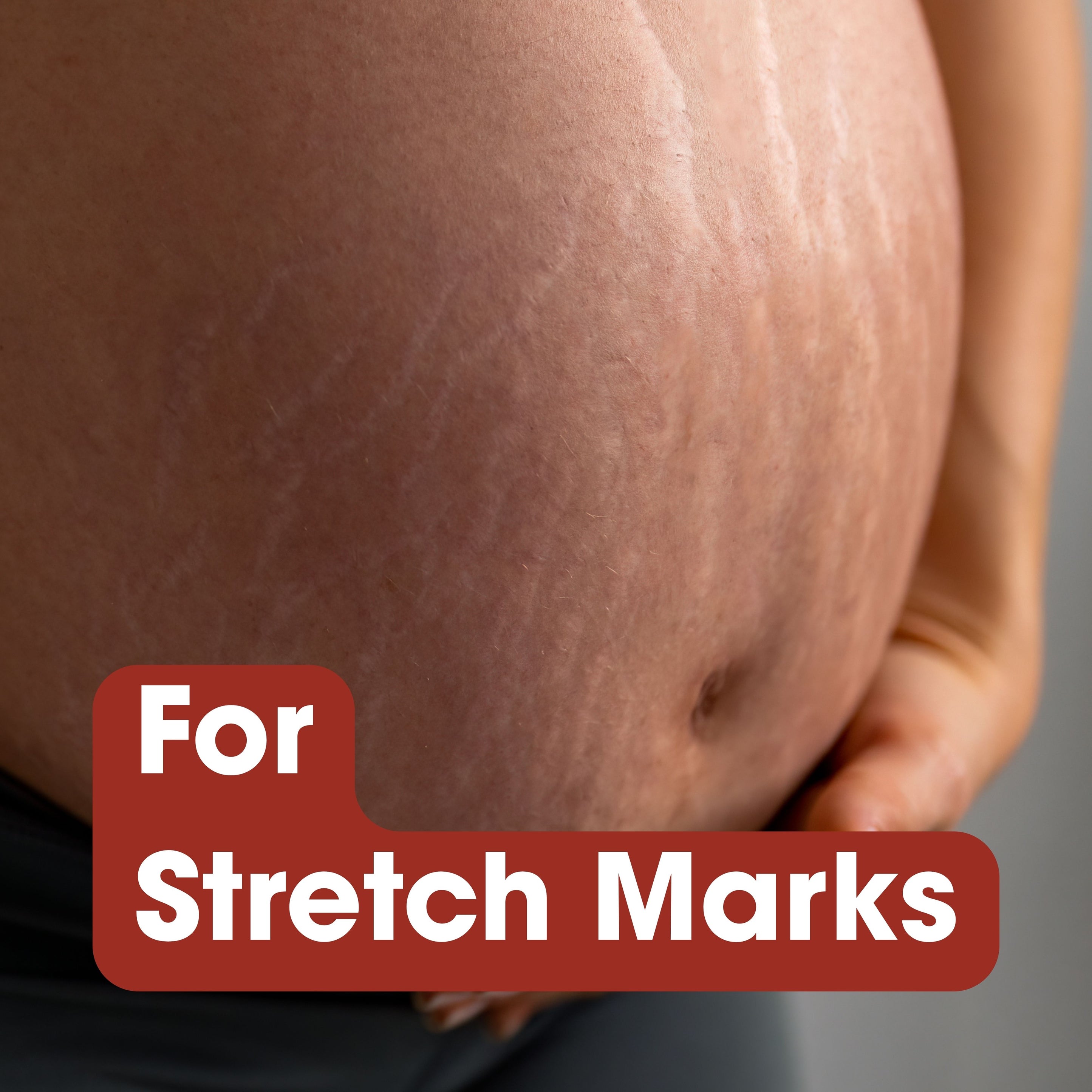 How Do You Get Rid of White Stretch Marks? – Afterthought